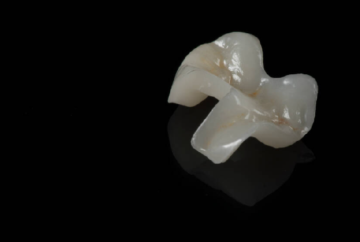 Incrustación dental: Inlay y Onlay :: Clinica Dental Boca Sana